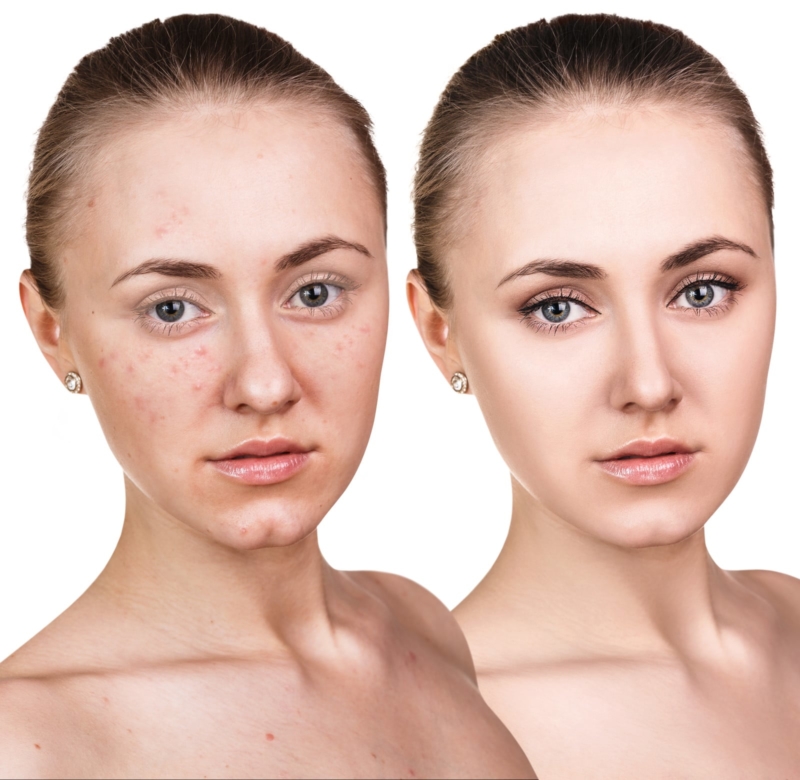 Certified Acne Care Clinic • Apeel Aesthetics